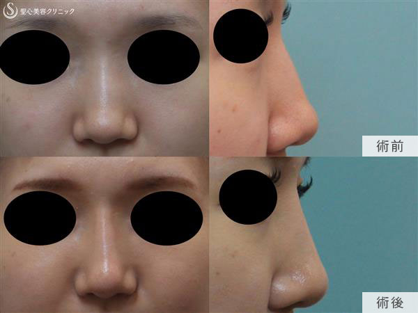 鼻先の手前の段差を改善 鼻の整形「鼻先」の症例写真 福岡の美容整形・外科・皮膚科なら聖心美容クリニック福岡院